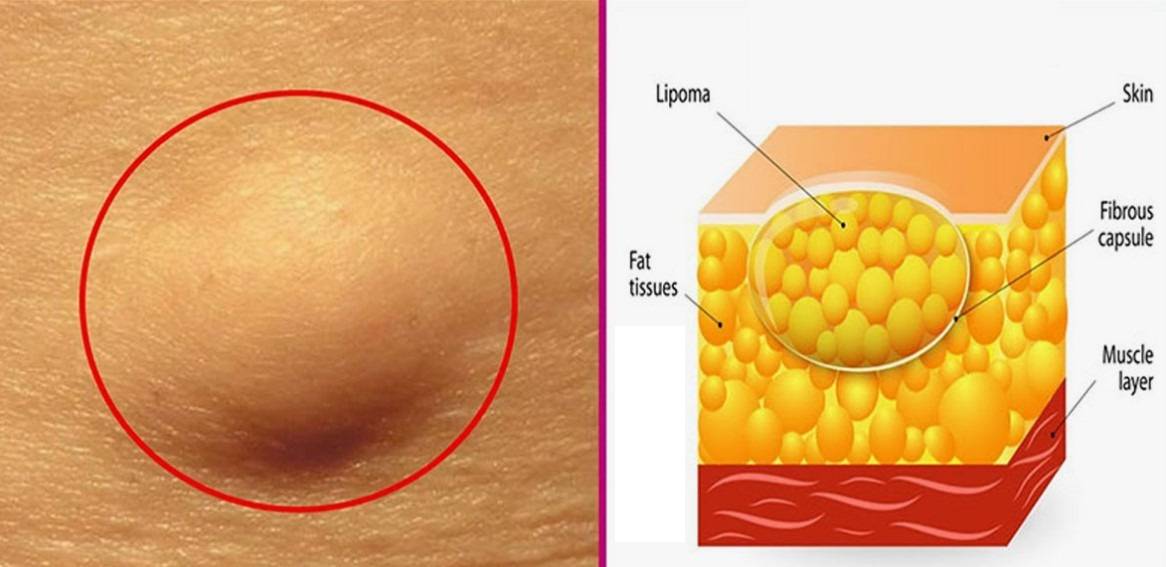 Lipomas: O Que São, Sintomas e Quando Procurar Ajuda?